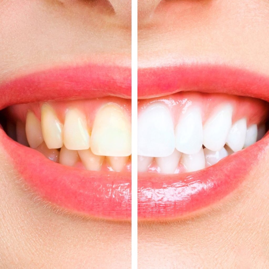 The Complete Guide to GlorySmile V34: Mastering Teeth Whitening ...